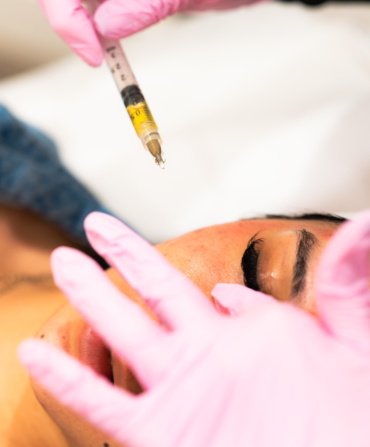 PRP Treatment Glendale | PRP Treatment Burbank | The Skin Agency